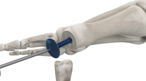 Accufix Surgical® | Choose Function Over Fusion