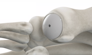 Accufix Surgical® | Choose Function Over Fusion